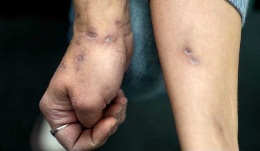 Xylazine Wounds: Addressing the Dangers Of Opioid Addiction